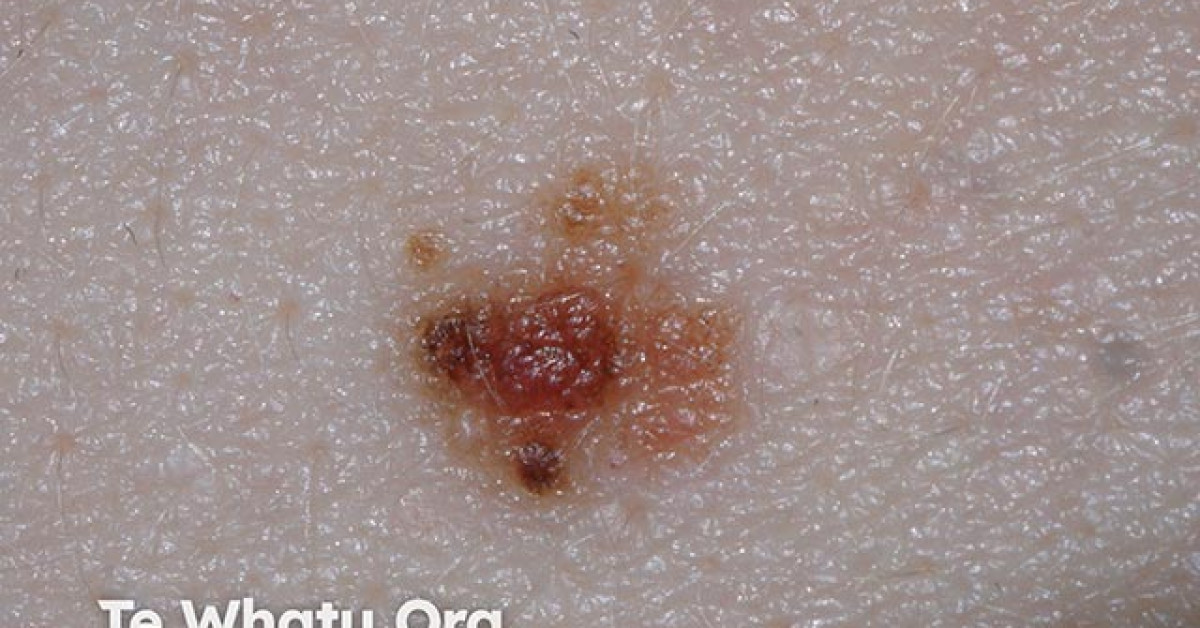 Atypical melanocytic naevus image