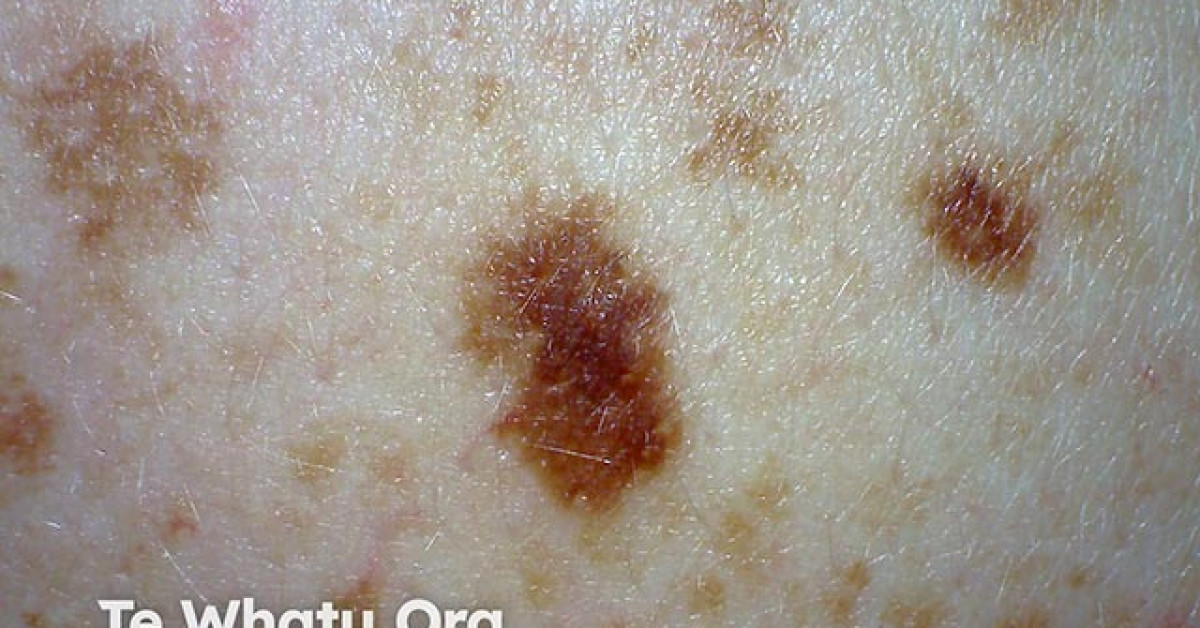 Atypical melanocytic naevus image