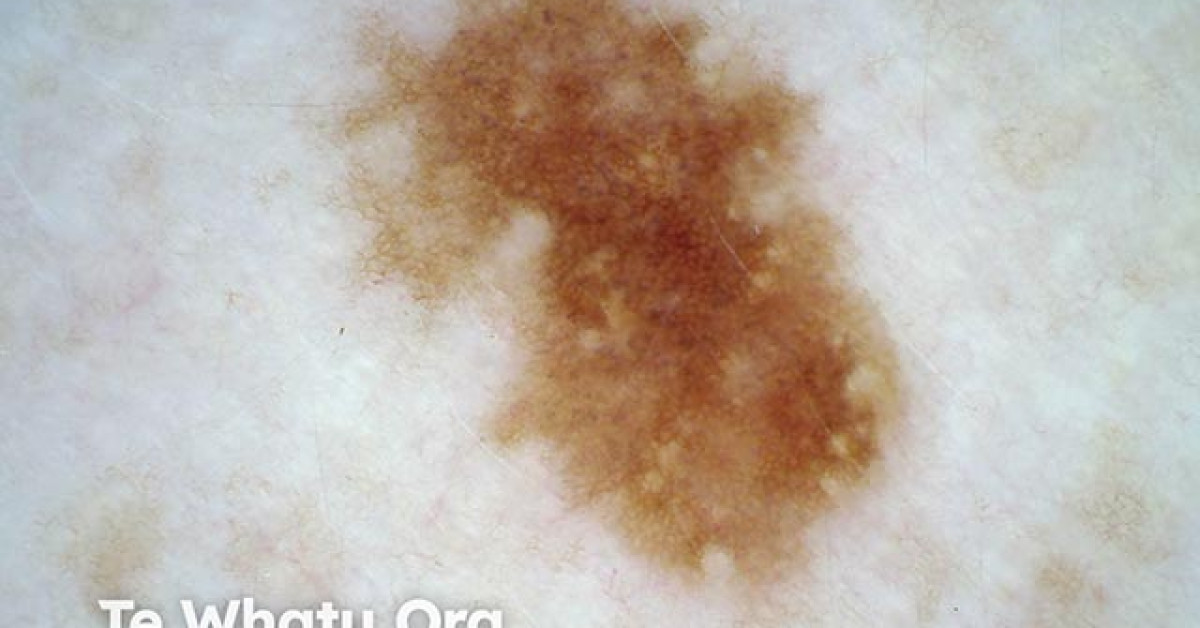 Atypical melanocytic naevus image