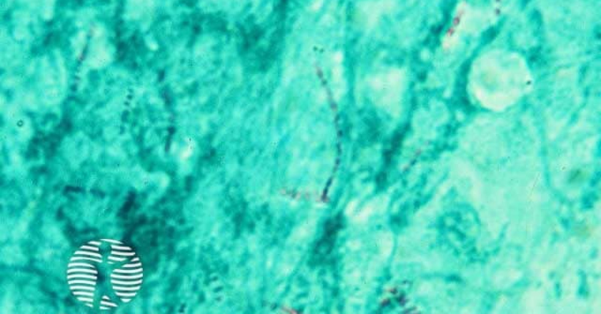 Atypical mycobacteria infection image