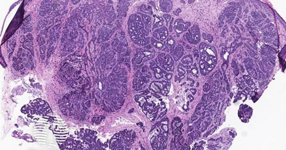 Basal cell carcinoma histopathology image