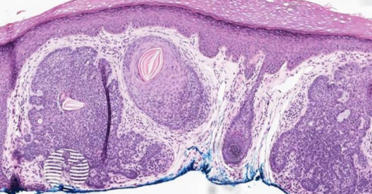 Basal cell carcinoma histopathology image