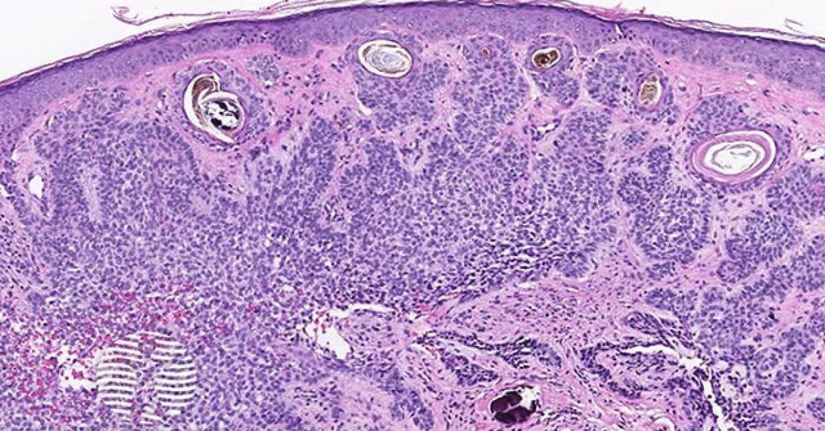 Basal cell carcinoma histopathology image