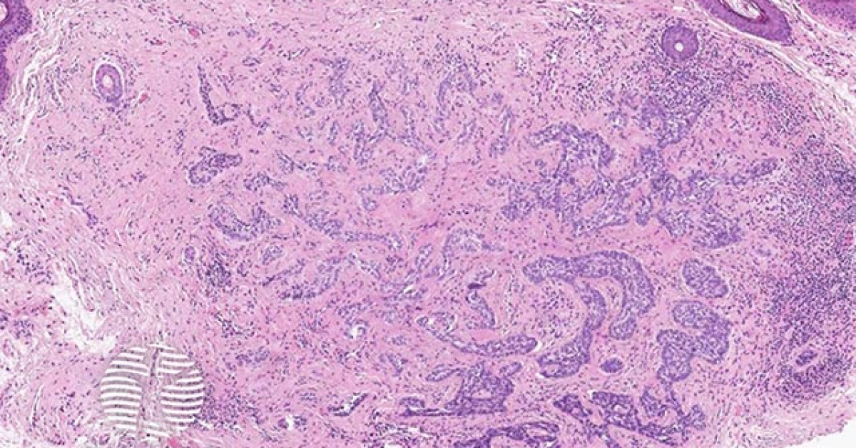 Basal cell carcinoma histopathology image