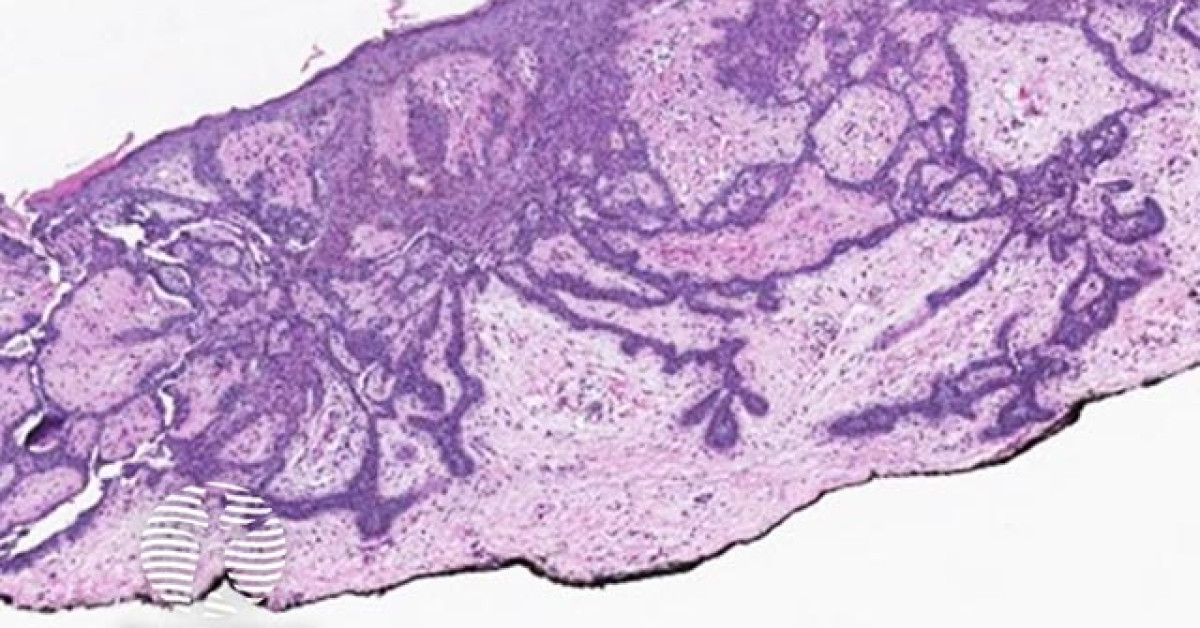 Basal cell carcinoma histopathology image