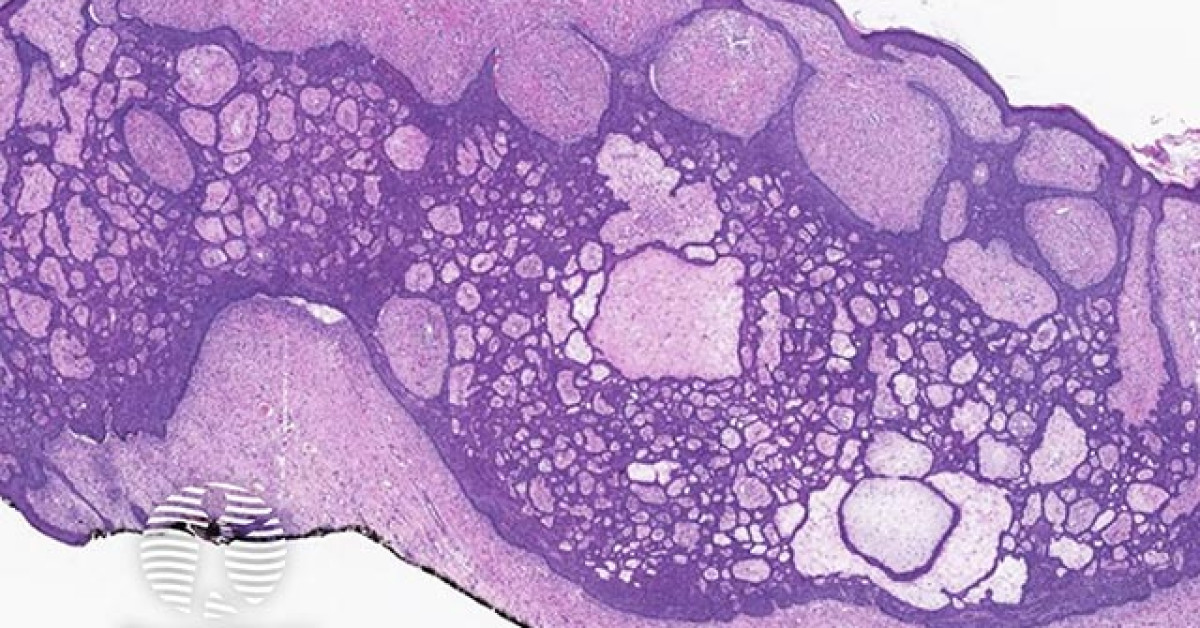 Basal cell carcinoma histopathology image