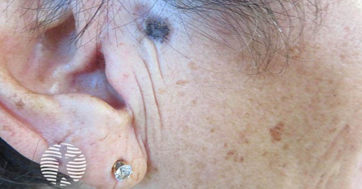 Basal cell carcinoma image