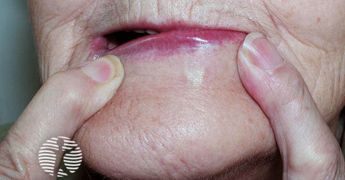 Basal Cell Carcinoma Lip