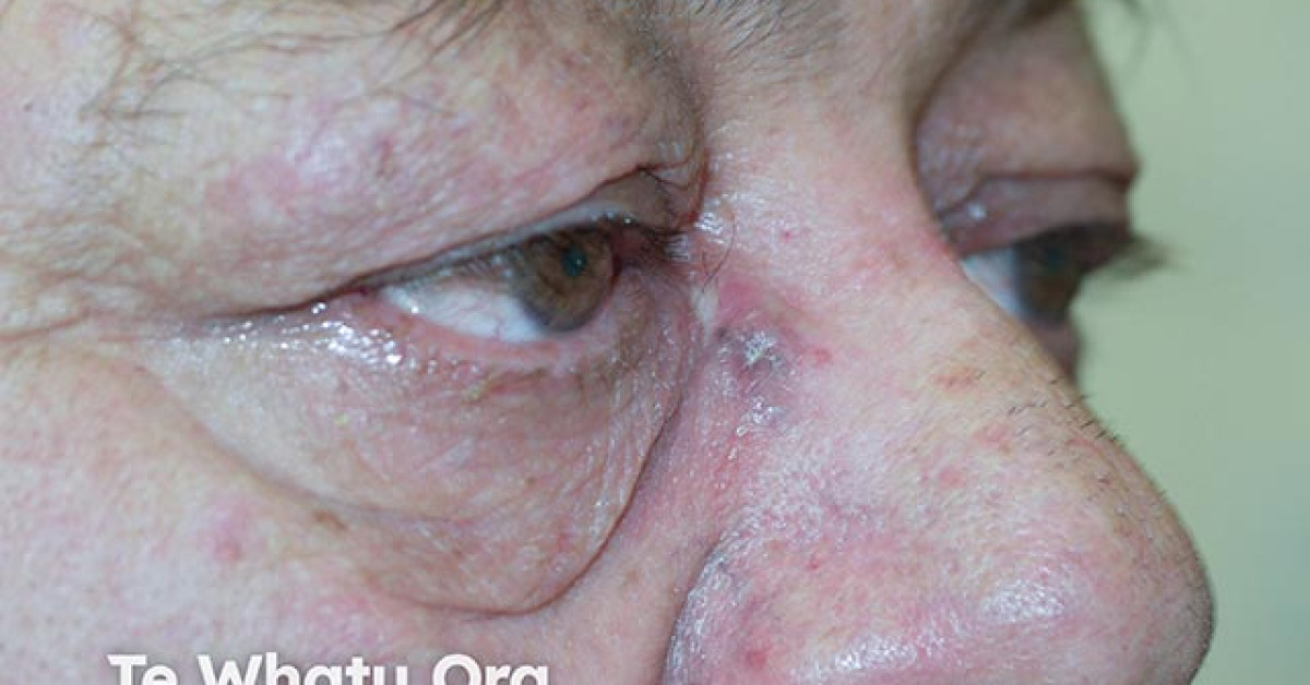 Basal cell carcinoma image