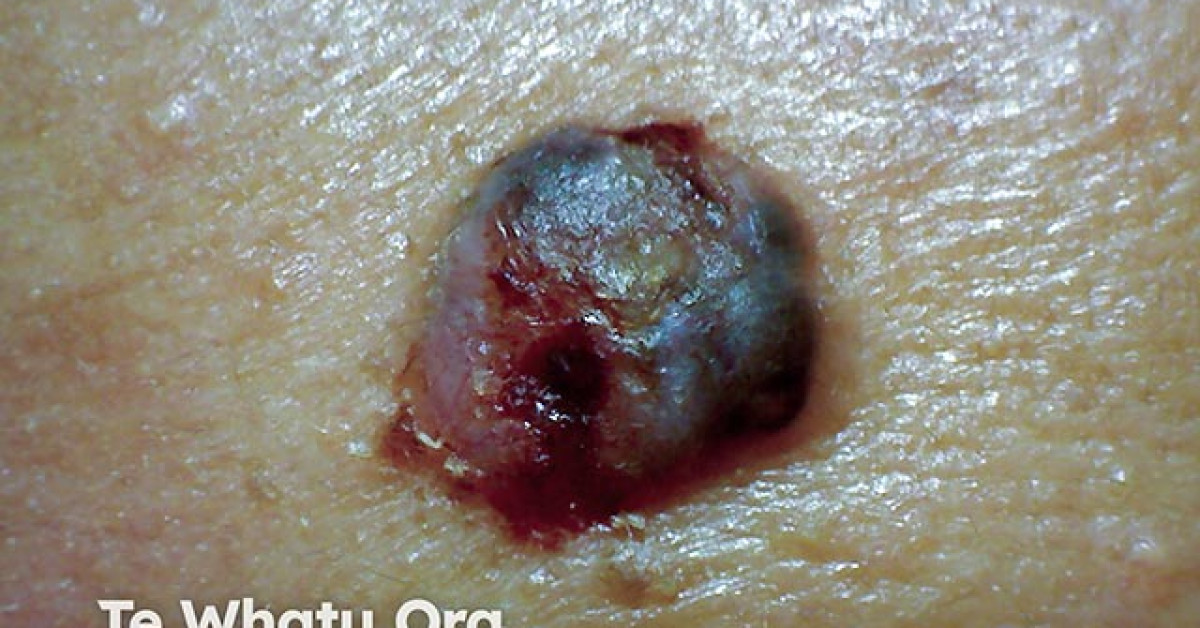 Basal cell carcinoma in skin of colour image