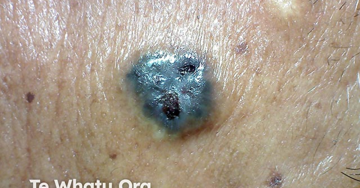 Basal cell carcinoma image