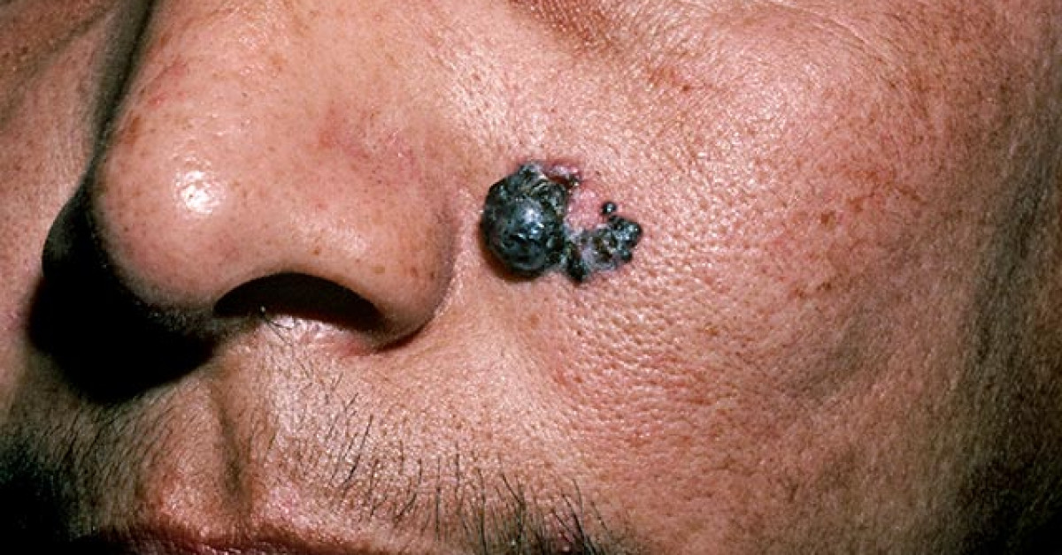 Basal cell carcinoma image