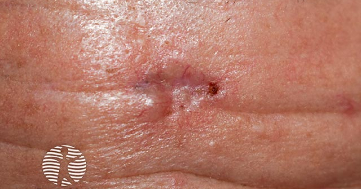 Basal cell carcinoma image