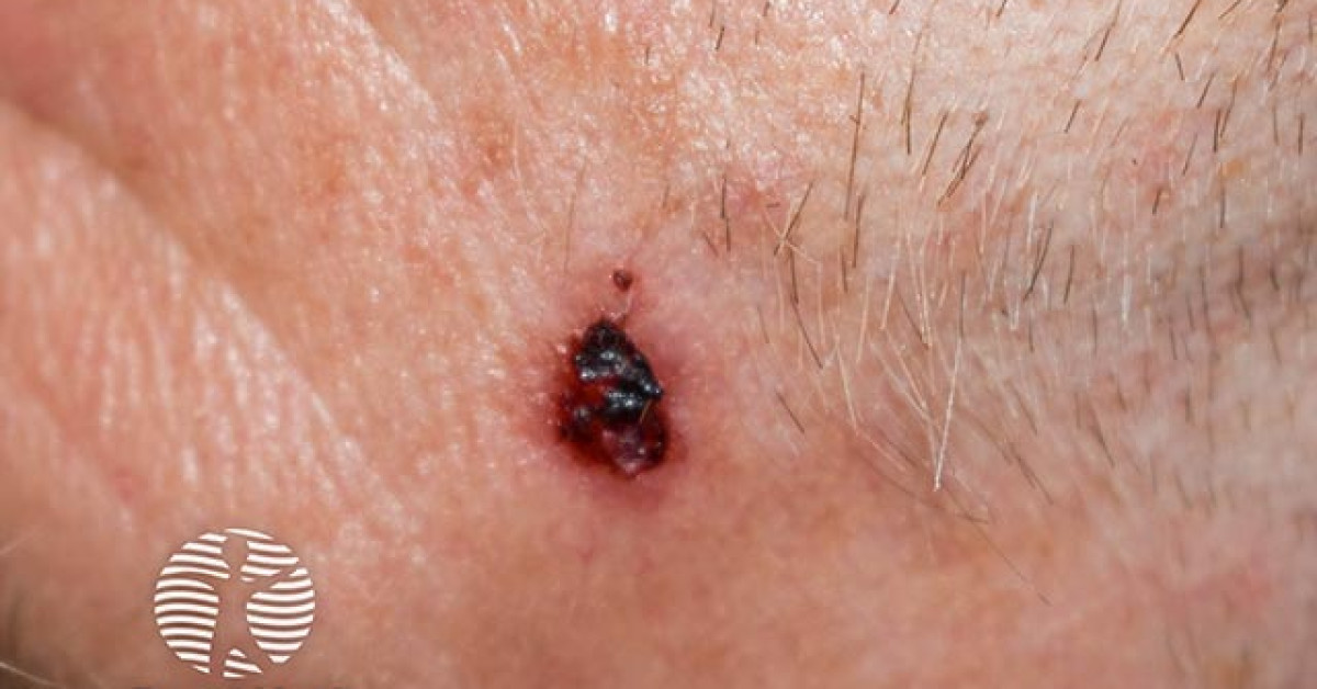 Basal cell carcinoma image