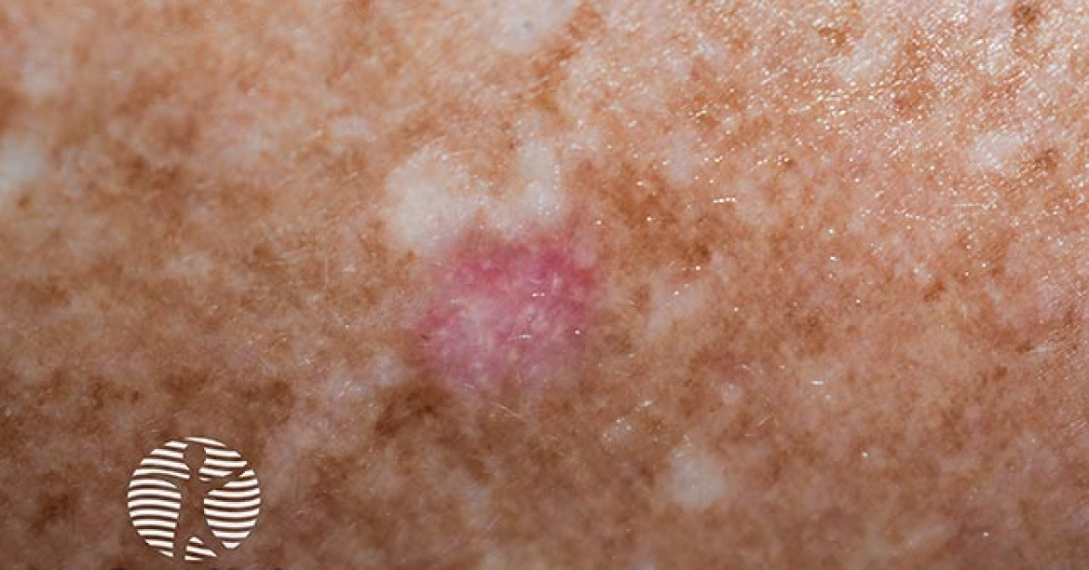 Basal cell carcinoma image