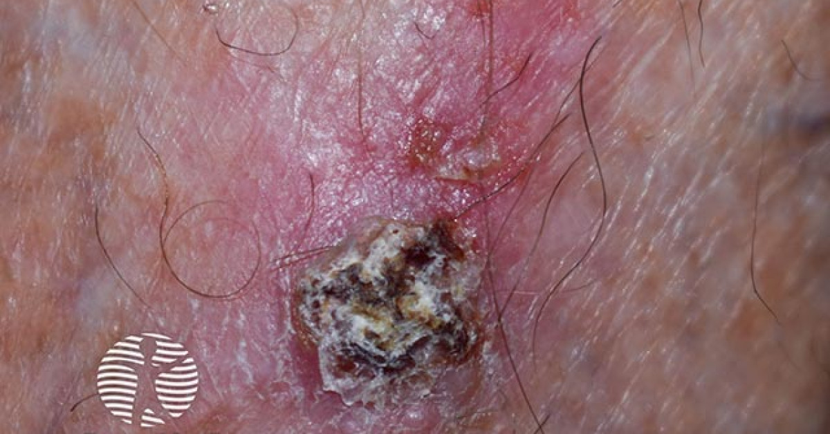 Basal cell carcinoma image