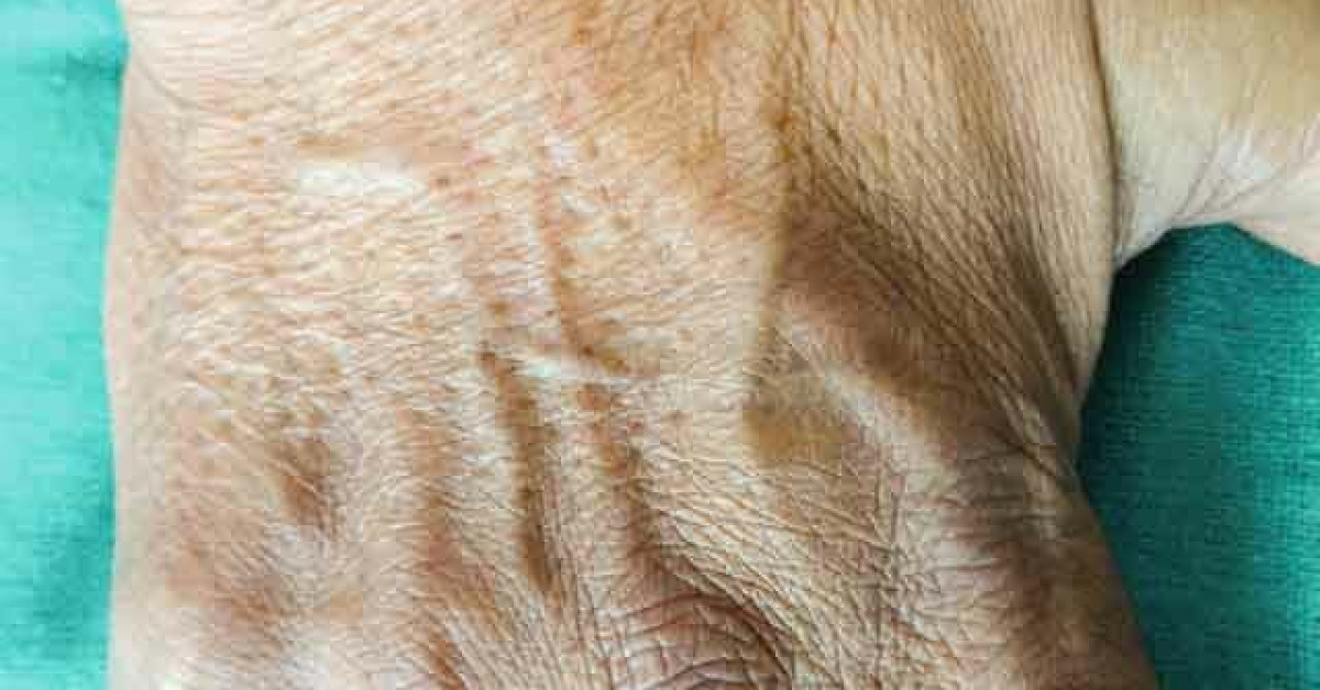 Bazex‑Dupré‑Christol syndrome image