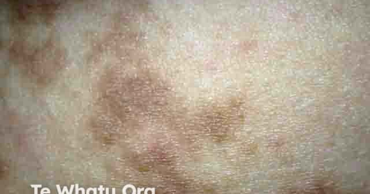 Becker naevus image