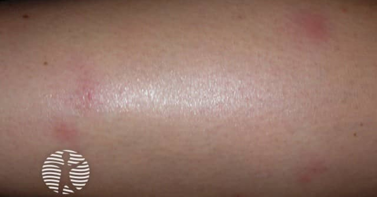 Bed bug infestation image