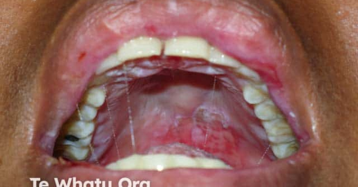 Behçet disease image