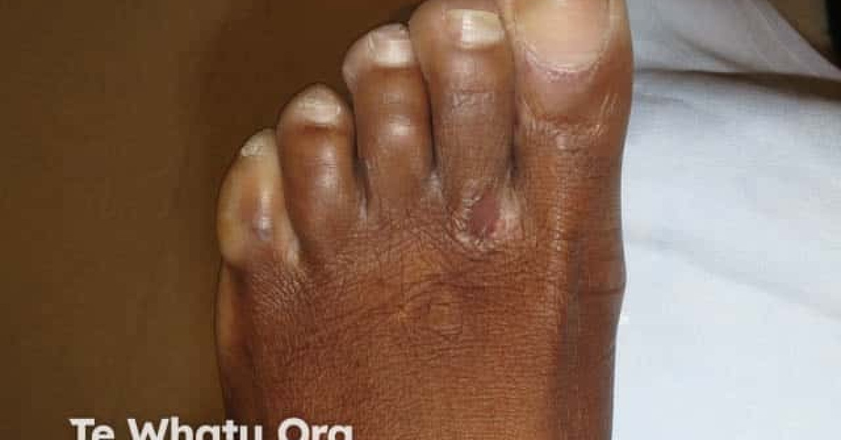 Behçet disease image