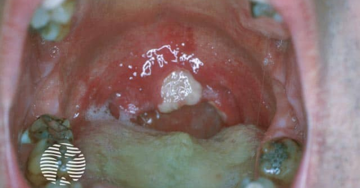 Behçet disease image