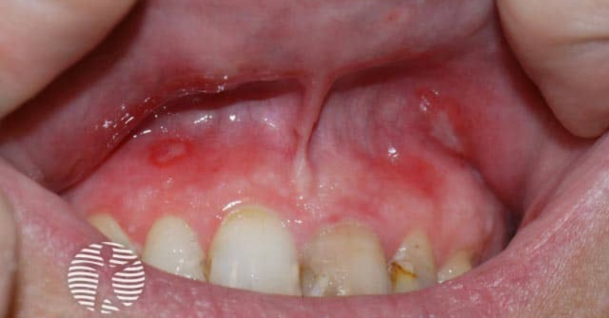 Behçet disease image