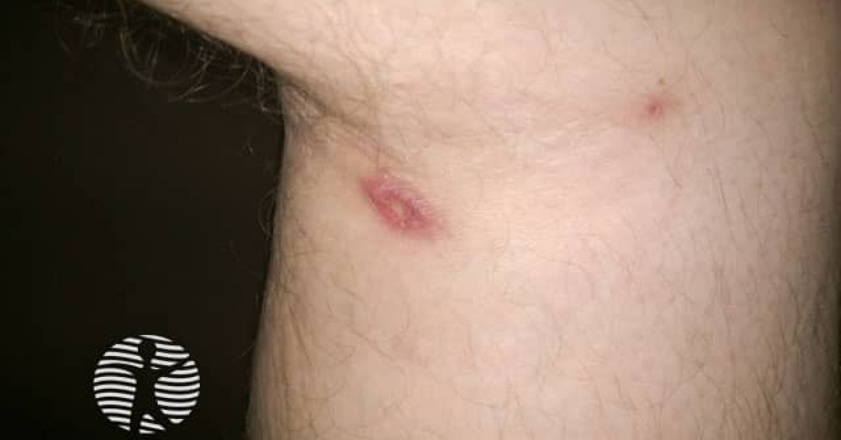 Behçet disease image
