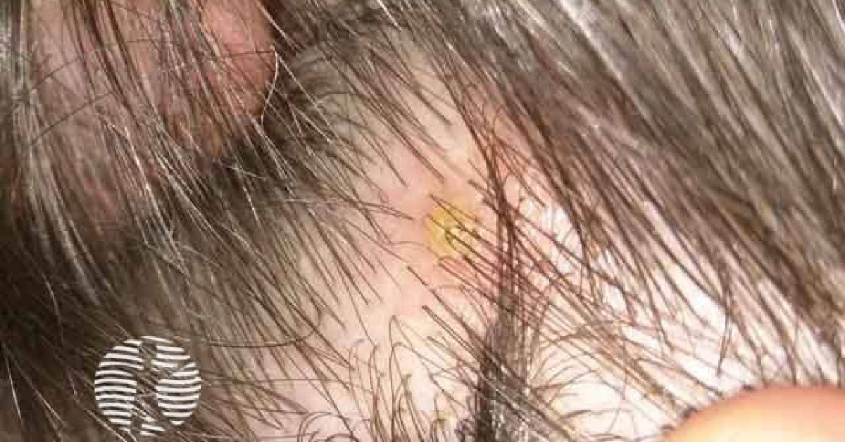 Behçet disease image