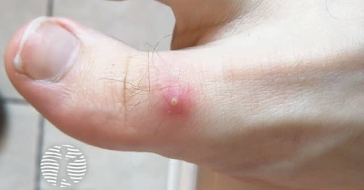 Behçet disease image