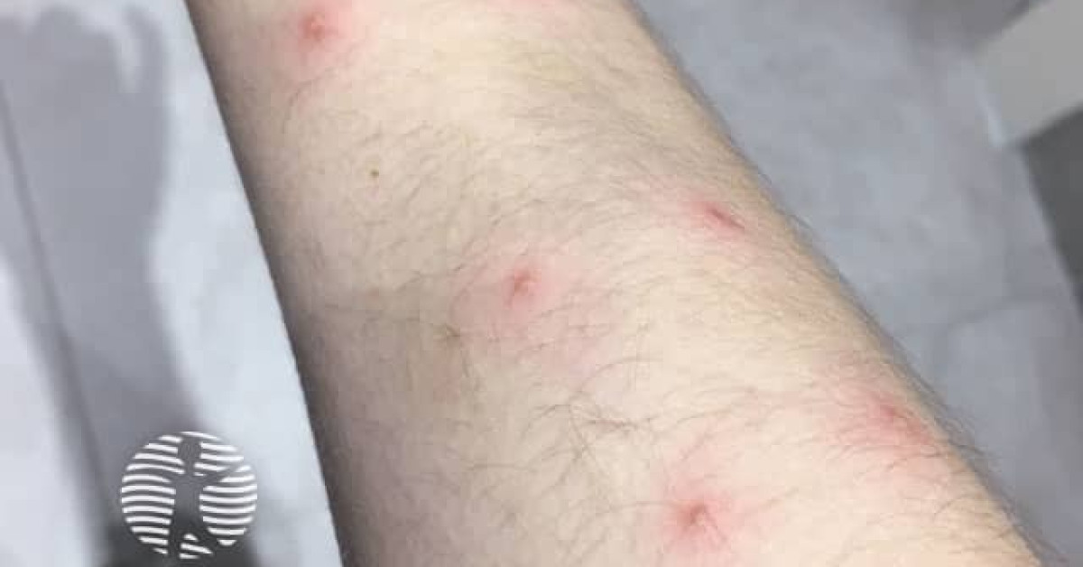 Behçet disease image