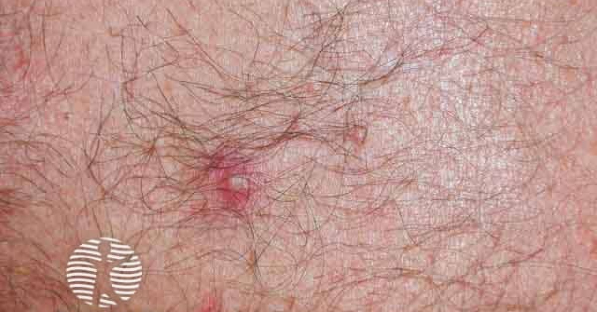 Behçet disease image