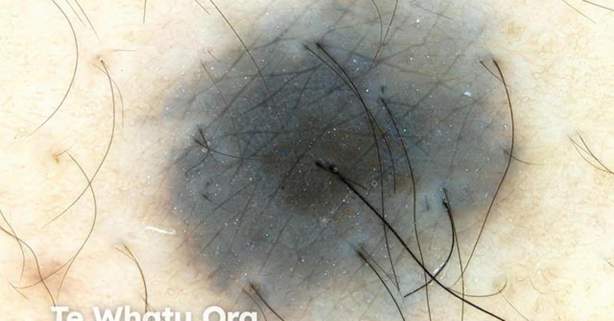 Blue naevus image