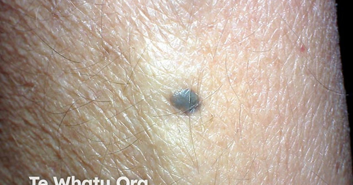 Blue naevus image
