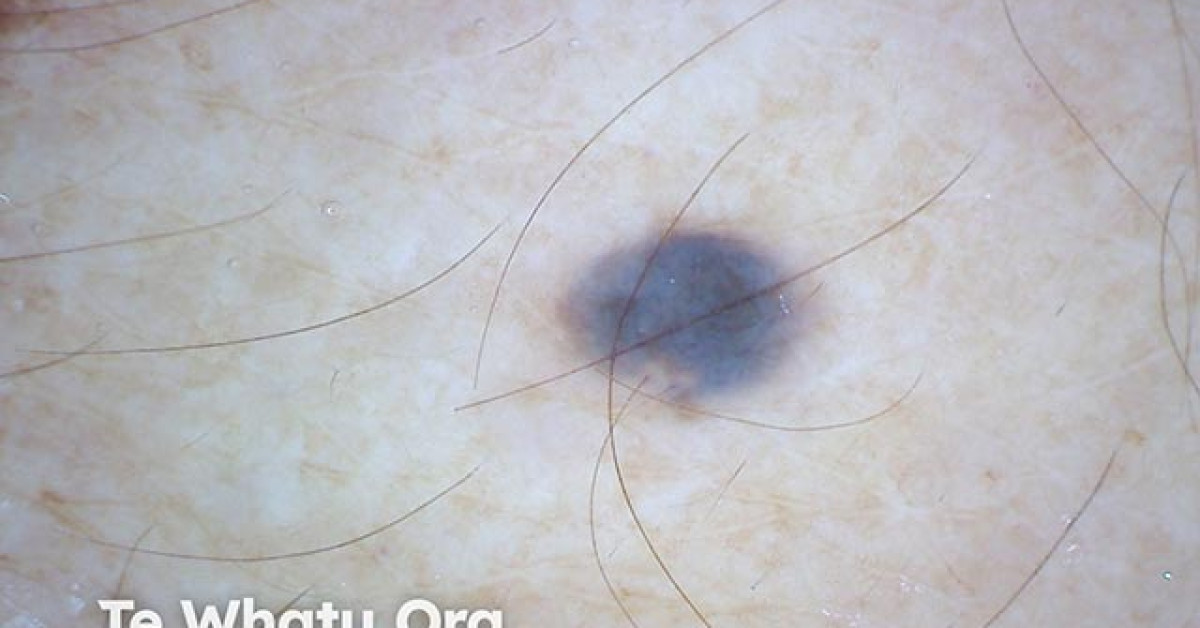 Blue naevus image