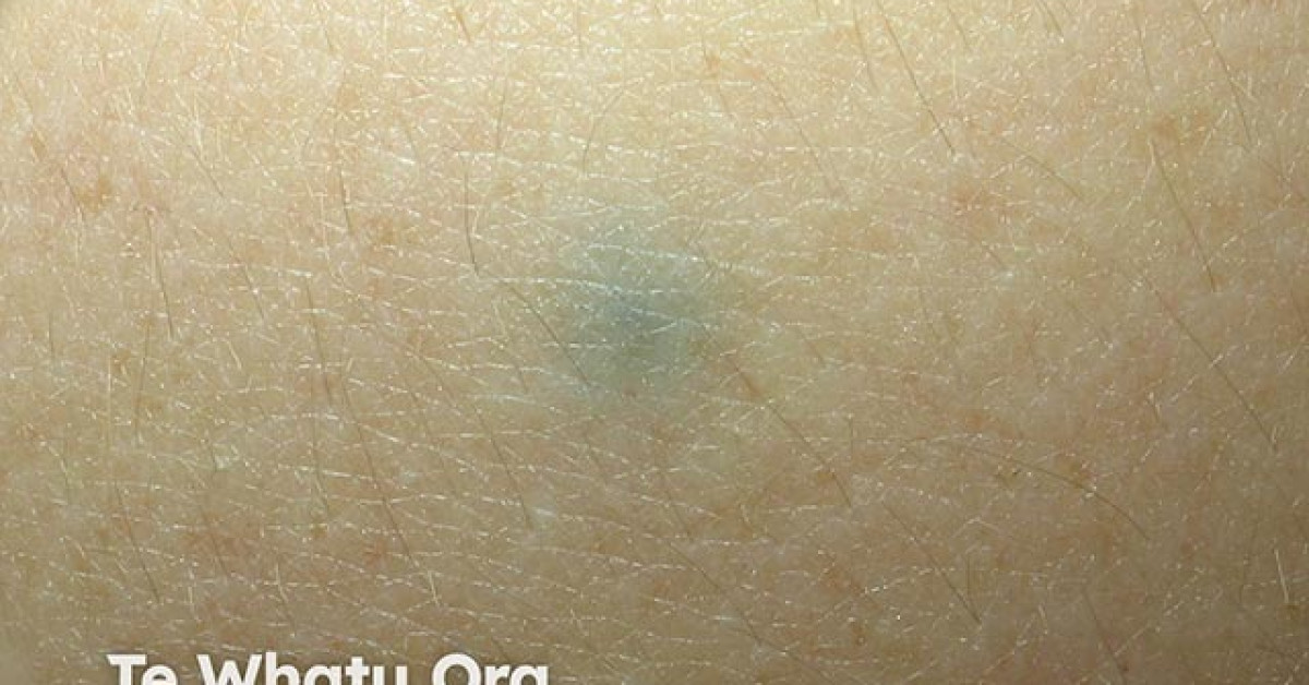 Blue naevus image