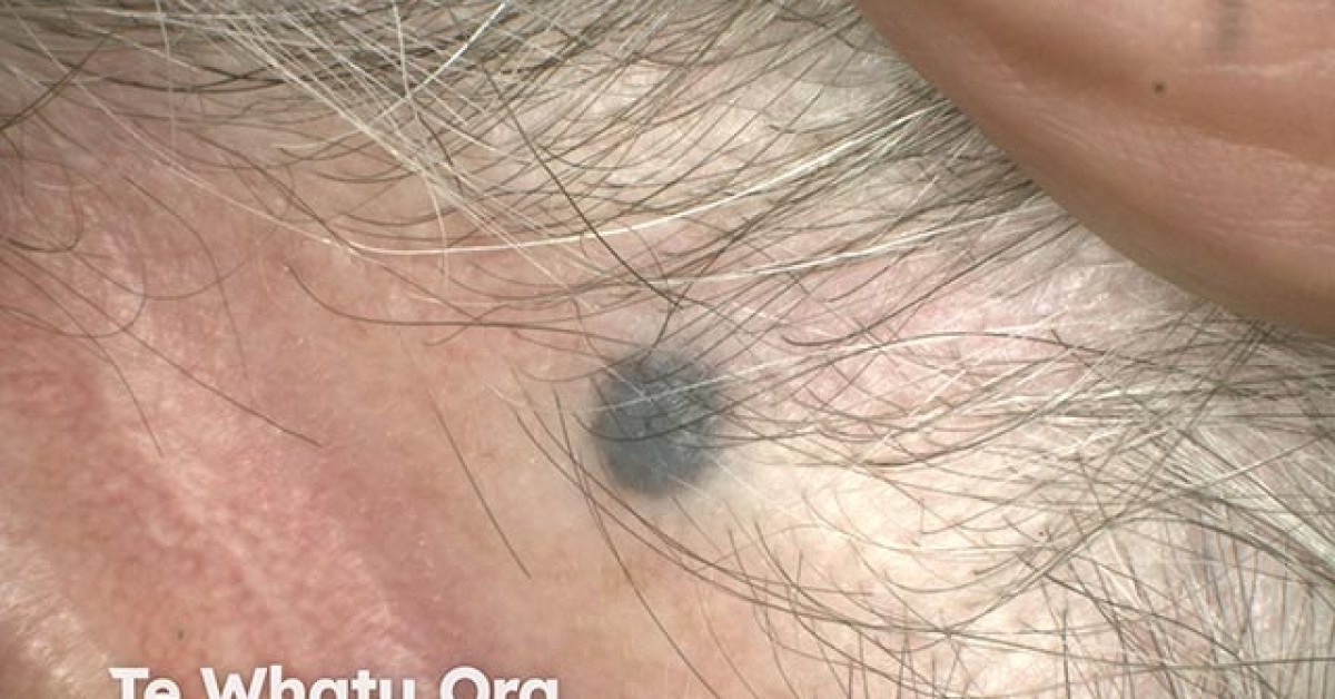 Blue naevus image
