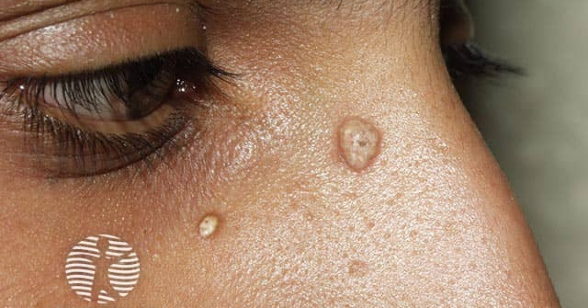 Calcinosis cutis image