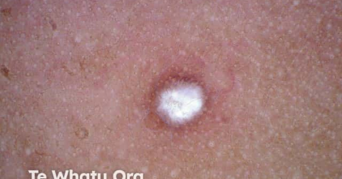 Calcinosis cutis image