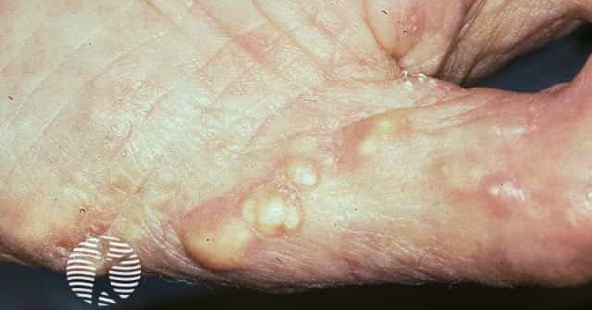 Calcinosis cutis image