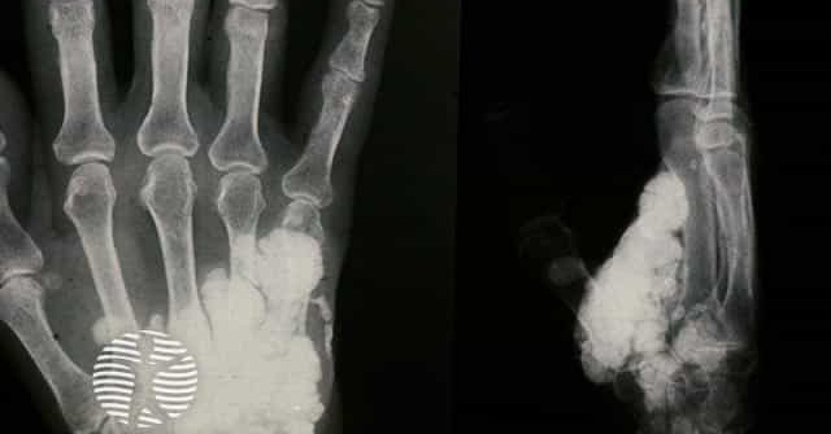 Calcinosis cutis image