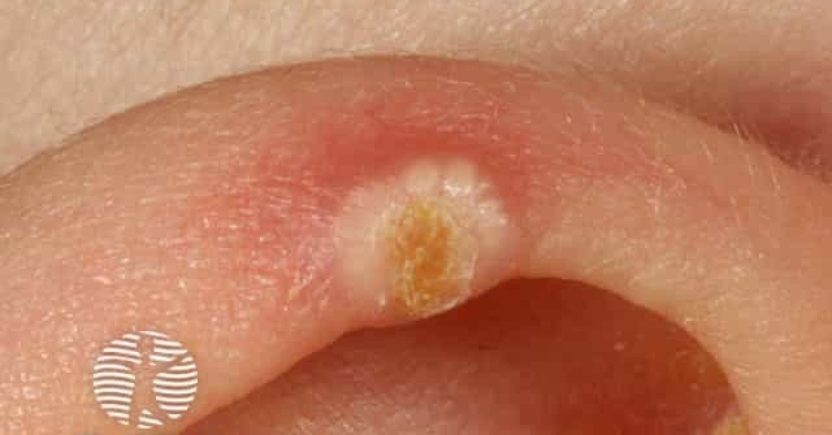 Calcinosis cutis image