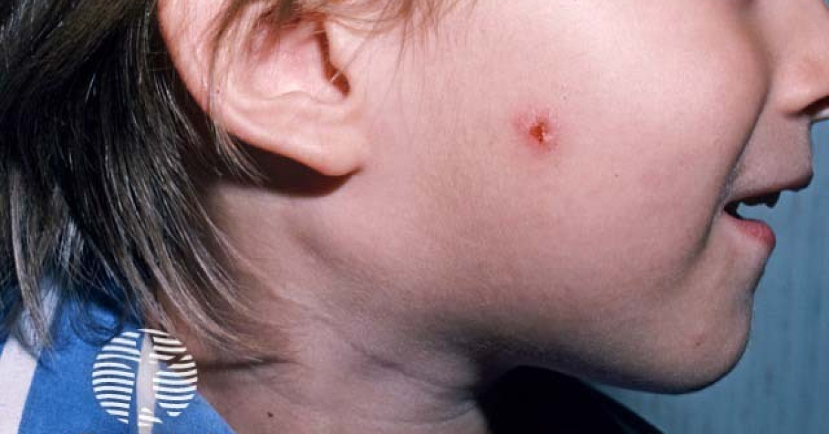 Cat scratch disease image