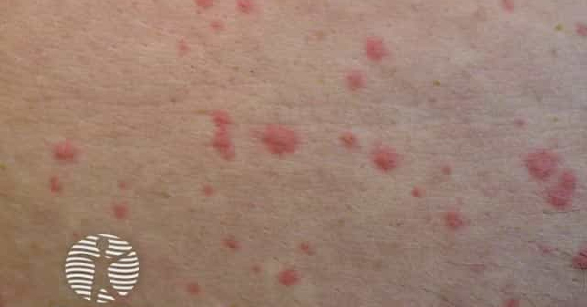 Cholinergic urticaria image