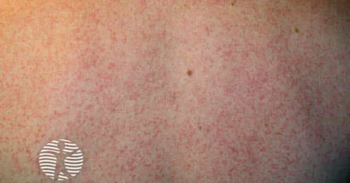 Cholinergic urticaria image