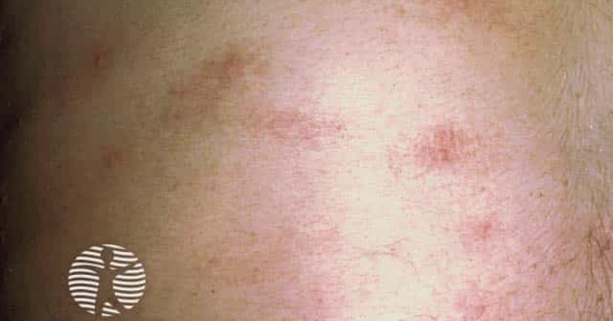 Cholinergic urticaria image