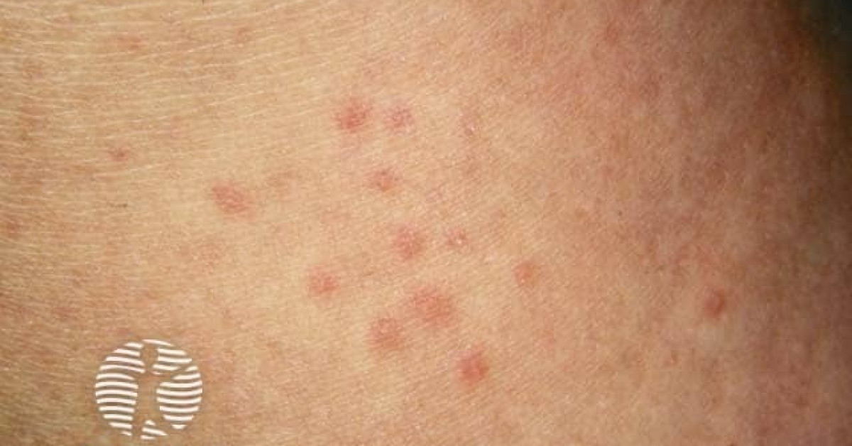Cholinergic urticaria image