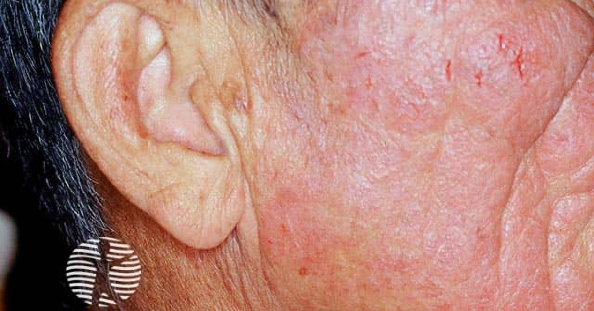 Chronic actinic dermatitis image