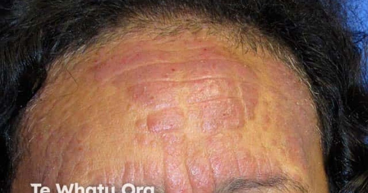 Chronic actinic dermatitis image