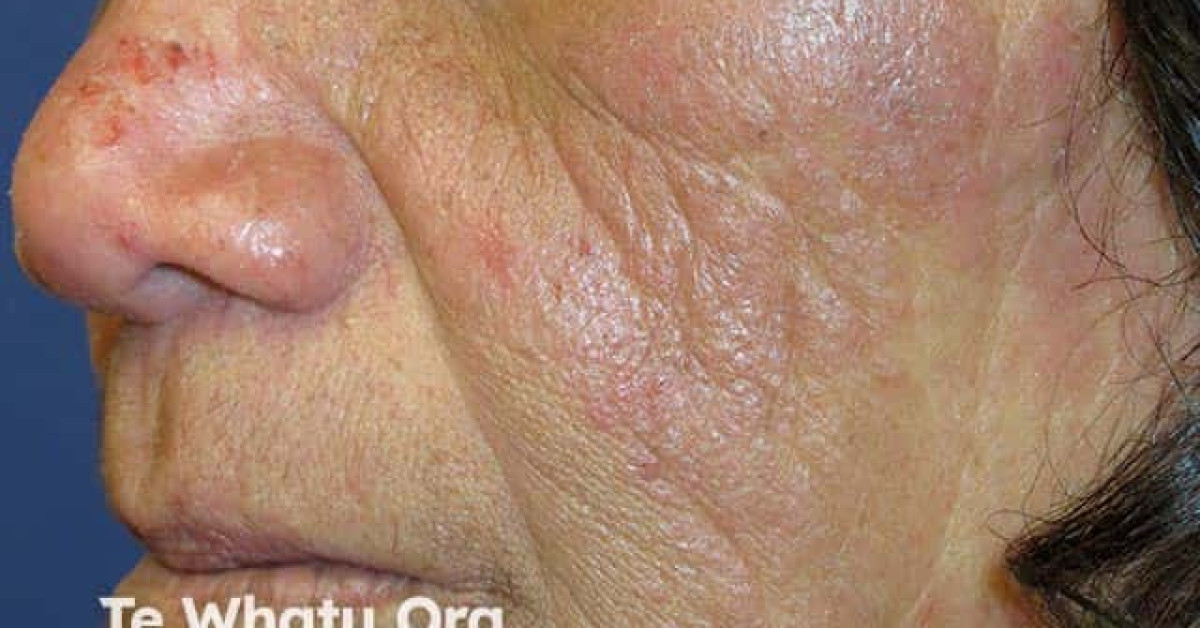 Chronic actinic dermatitis image